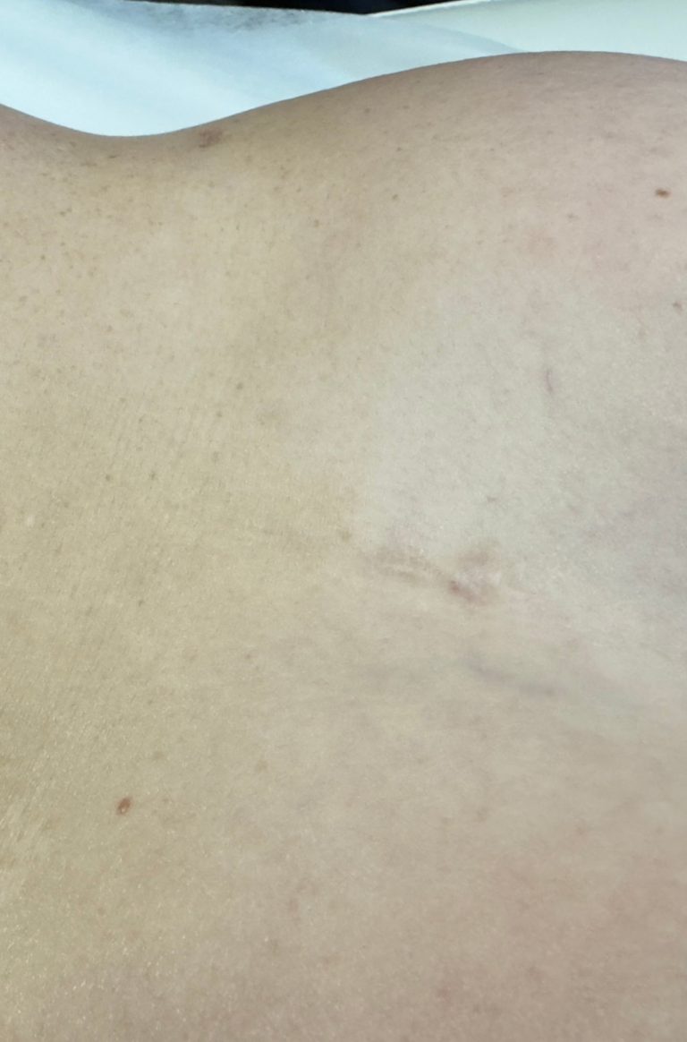 Liposuction Scars - Don't Wait 2 Rejuvenate - Don't Wait 2 Rejuvenate